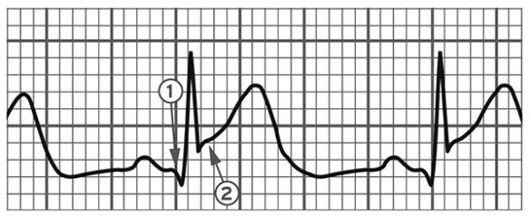 Electrocardiogram in Acute Coronary Syndrome | www.cimjournal.com
