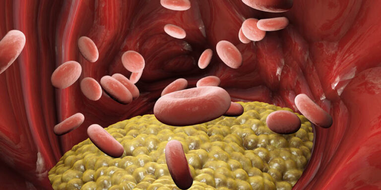 Hypertriglyceridemia ภาวะไตรกลีเซอไรด์สูงในเลือด | www.cimjournal.com