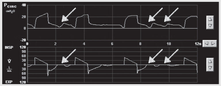 การแปลผลรูปคลื่นของเครื่องช่วยหายใจ Ventilator waveform interpretation