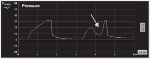 การแปลผลรูปคลื่นของเครื่องช่วยหายใจ Ventilator waveform interpretation