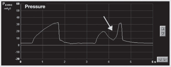การแปลผลรูปคลื่นของเครื่องช่วยหายใจ Ventilator waveform interpretation