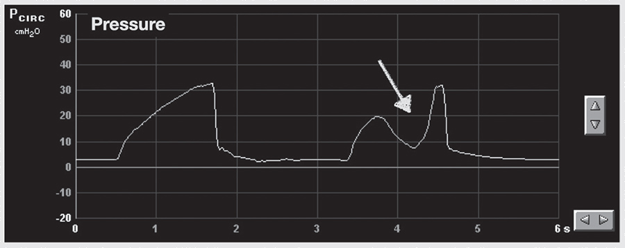 การแปลผลรูปคลื่นของเครื่องช่วยหายใจ Ventilator waveform interpretation