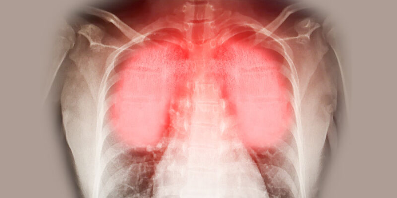 Guideline for DR-TB, MDR-TB and XDR-TB treatment in Thailand 2016