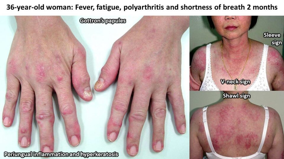 Spot Diagnosis in Rheumatology
