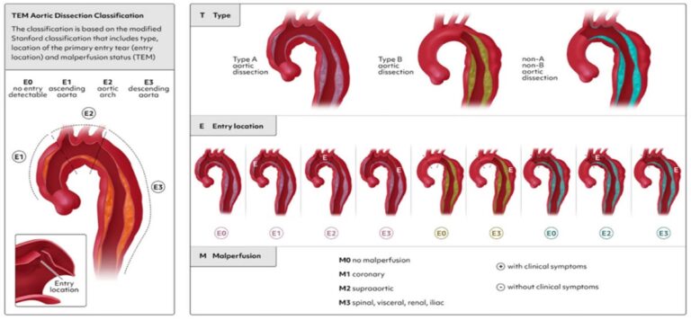 Update in Aortic Dissection - CIMjournal