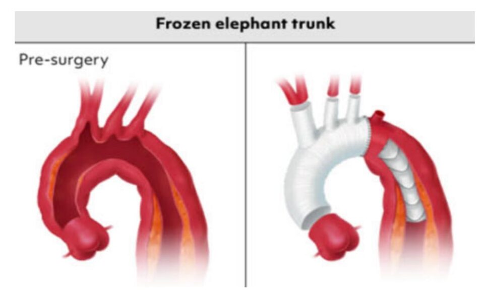 Update in Aortic Dissection - CIMjournal